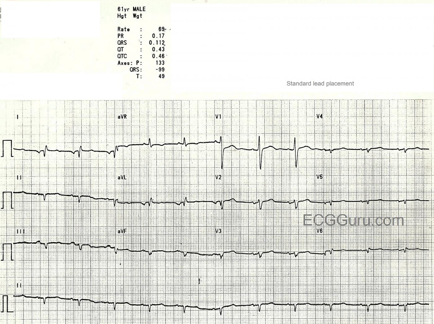 Dextrocardia | ECG Guru - Instructor Resources Dextrocardia | ECG Guru - Instructor Resources
